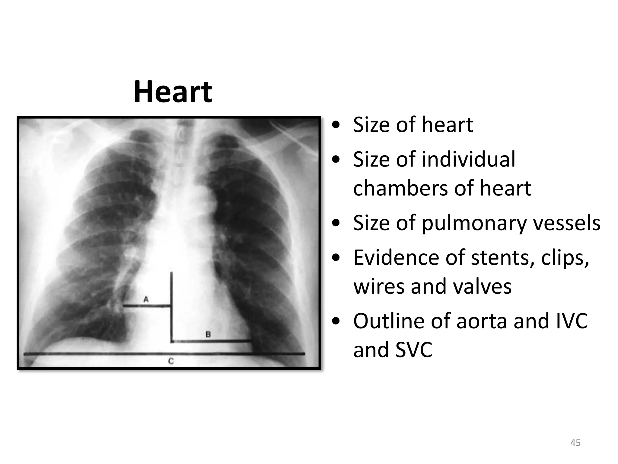 Basic CXR Interpretation_Diagnostic Radiographs | PDF