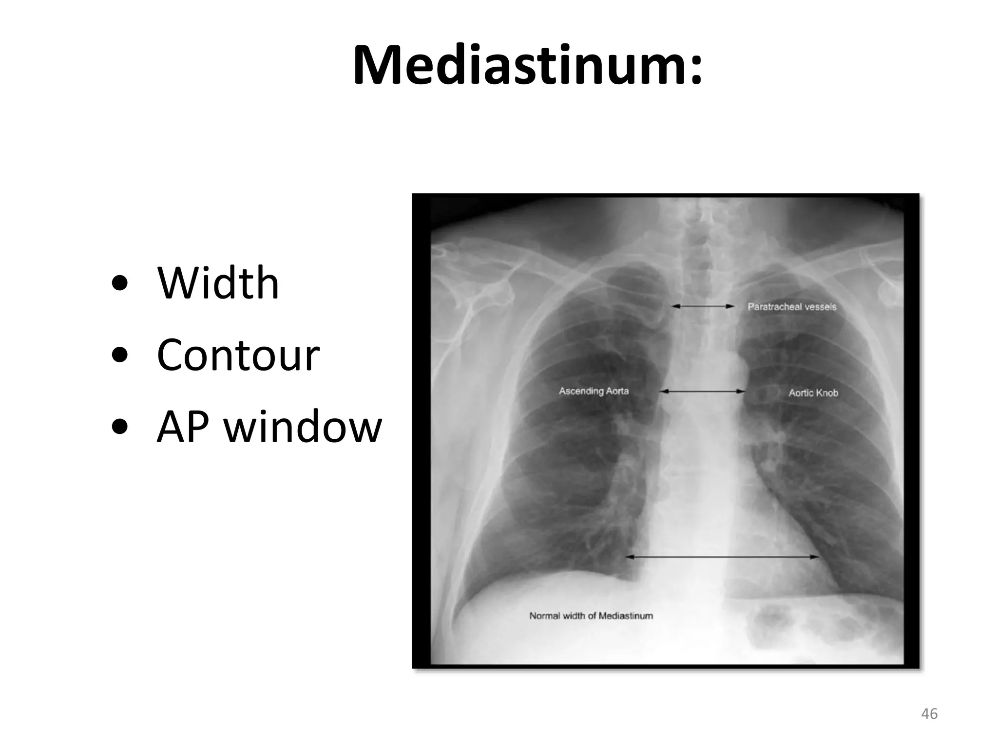 Basic CXR Interpretation_Diagnostic Radiographs | PDF