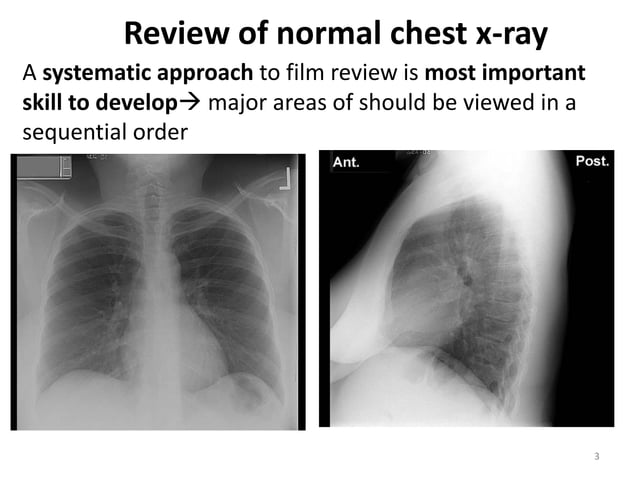 Basic CXR Interpretation_Diagnostic Radiographs | PDF