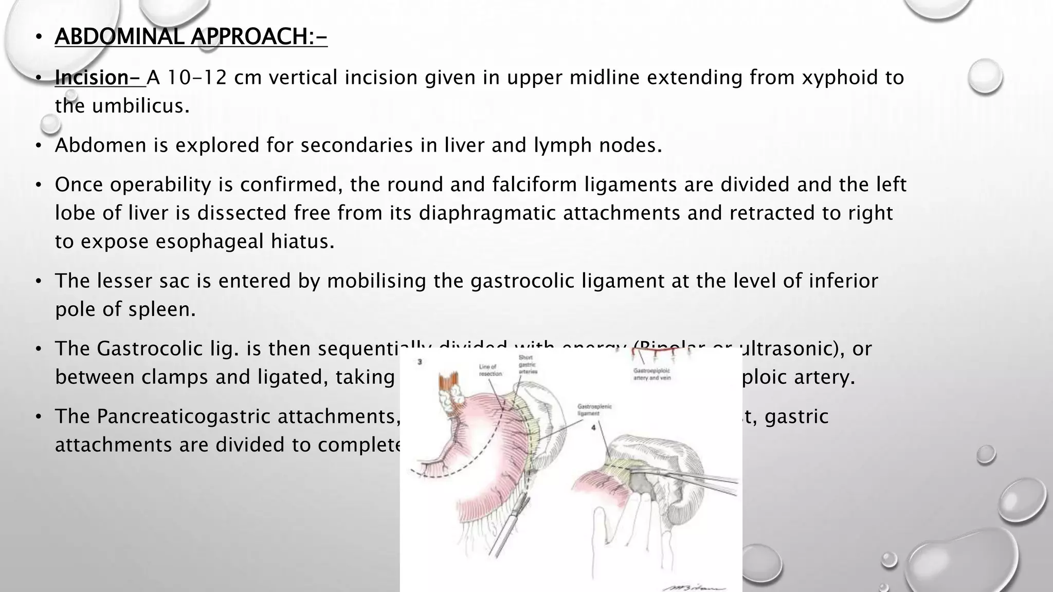 Ivor lewis esophagectomy | PPTX