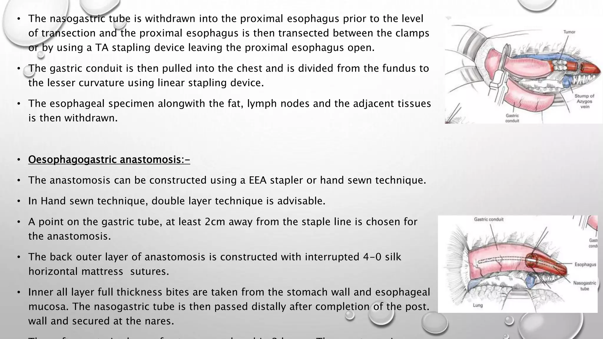 Ivor lewis esophagectomy | PPTX