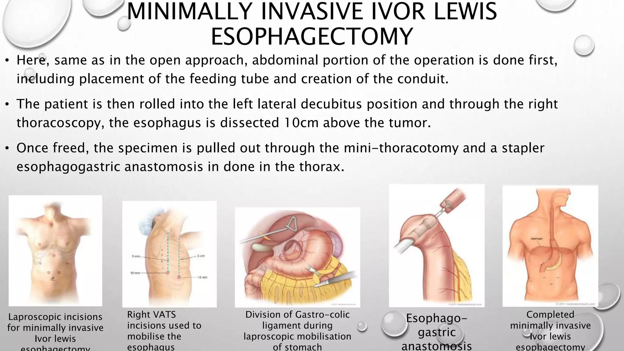 Ivor lewis esophagectomy | PPTX