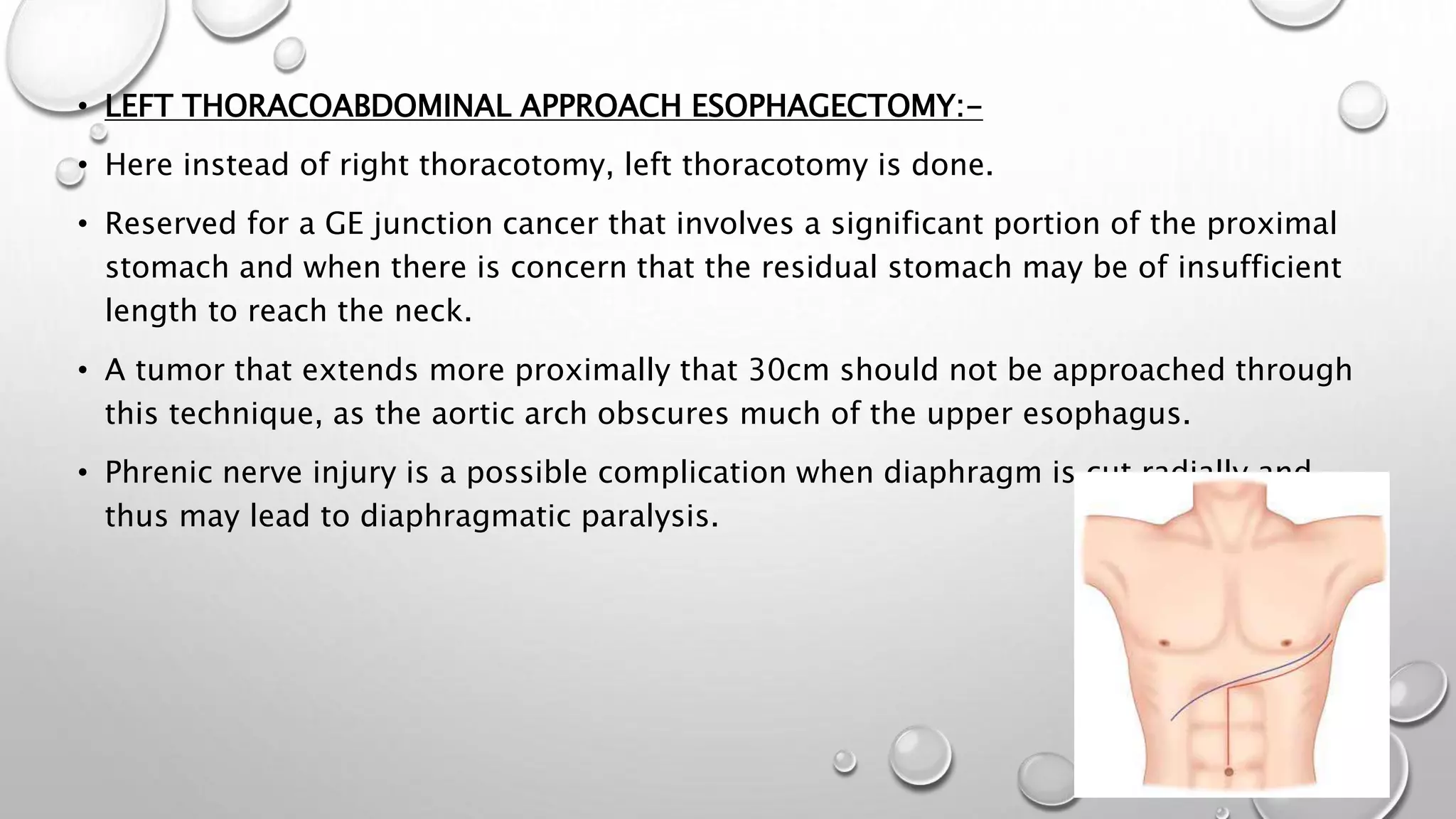 Ivor lewis esophagectomy | PPTX