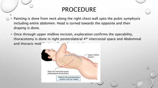 Ivor lewis esophagectomy | PPTX | Death, Injury, or Military Conflict ...