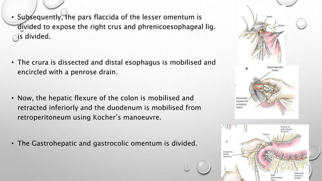 Ivor lewis esophagectomy | PPTX | Death, Injury, or Military Conflict ...