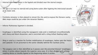 Ivor lewis esophagectomy | PPTX