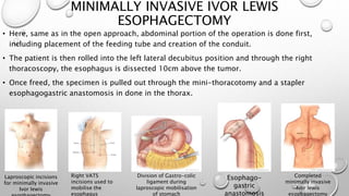 Ivor lewis esophagectomy | PPTX