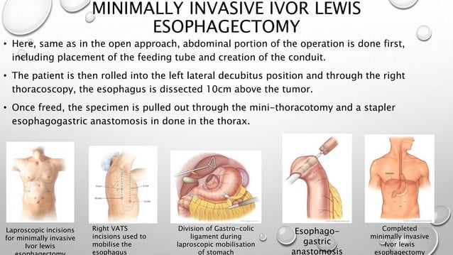 Ivor lewis esophagectomy | PPTX | Death, Injury, or Military Conflict ...