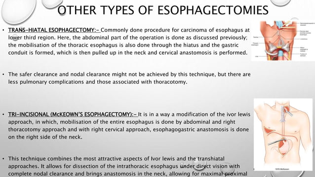 Ivor lewis esophagectomy | PPTX | Death, Injury, or Military Conflict ...