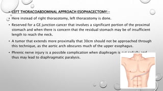 Ivor lewis esophagectomy | PPTX