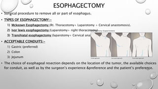 Ivor lewis esophagectomy | PPTX