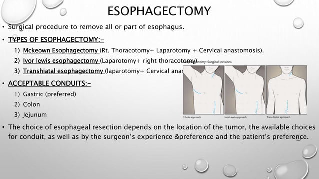 Ivor lewis esophagectomy | PPTX | Death, Injury, or Military Conflict ...
