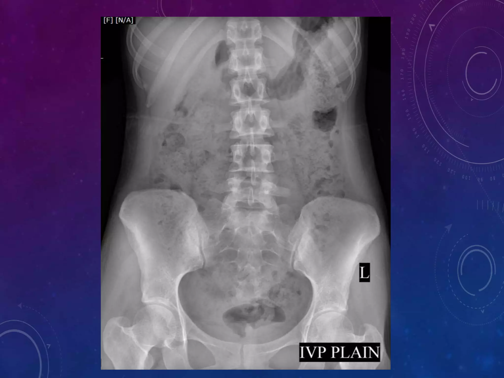 INTRAVENOUS UROGRAM (IVU) | PPTX