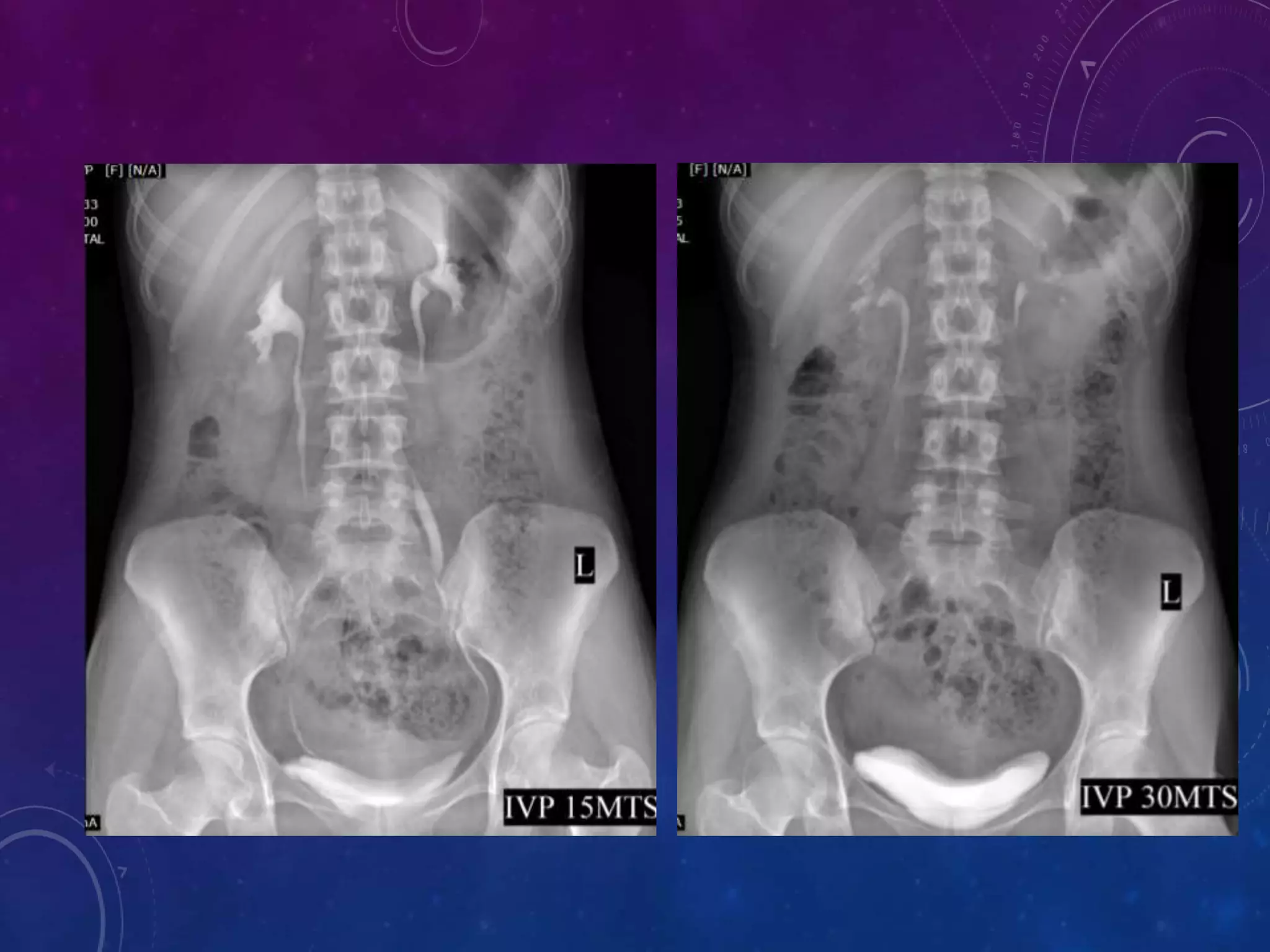 INTRAVENOUS UROGRAM (IVU) | PPTX