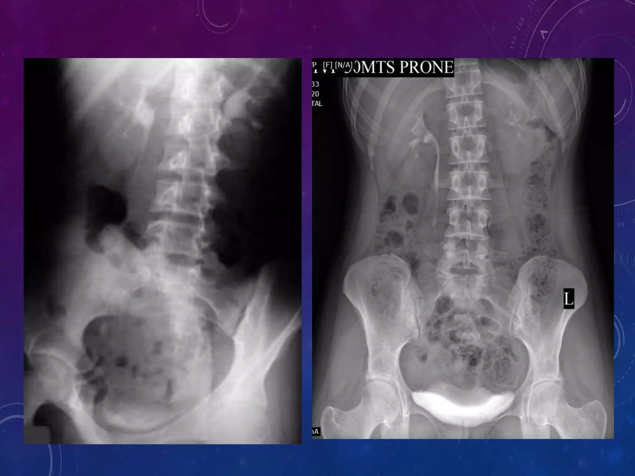 INTRAVENOUS UROGRAM (IVU) | PPTX