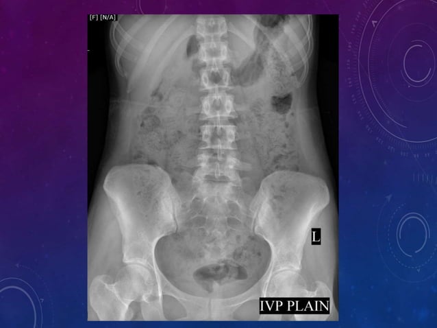 INTRAVENOUS UROGRAM (IVU) | PPTX