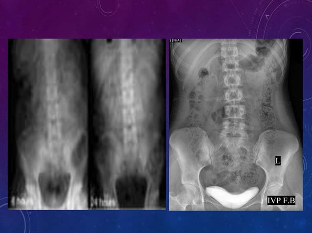INTRAVENOUS UROGRAM (IVU) | PPTX