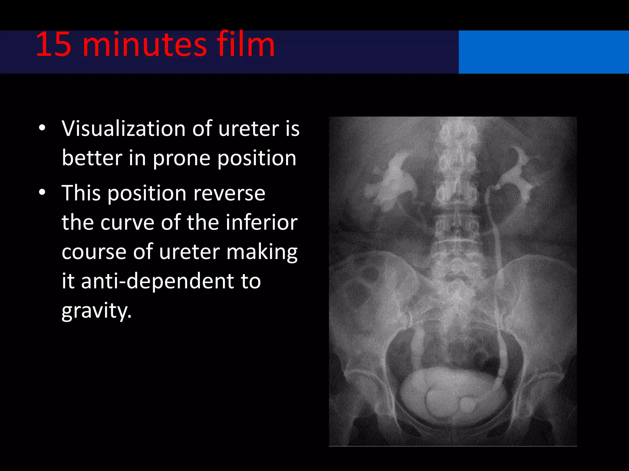 IVP, RGU & MCU | PPTX | Digestive Disorders | Diseases and Conditions