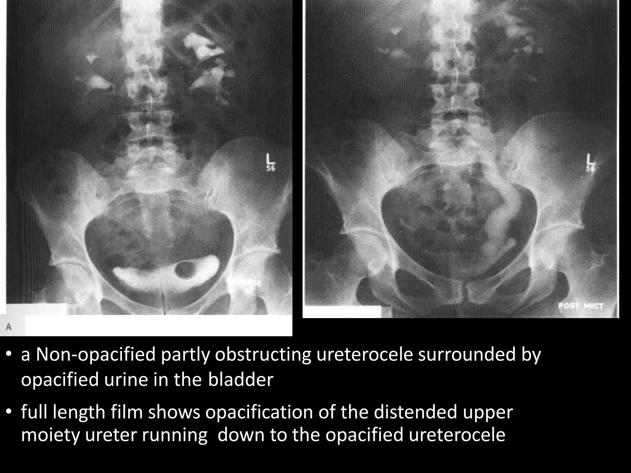 IVP, RGU & MCU | PPTX | Digestive Disorders | Diseases and Conditions