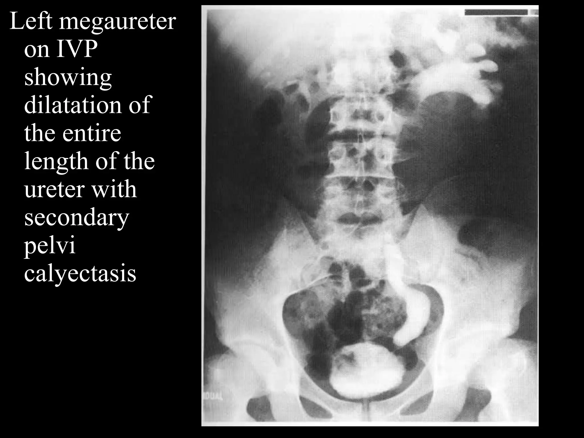 IVP, RGU & MCU | PPTX | Digestive Disorders | Diseases and Conditions