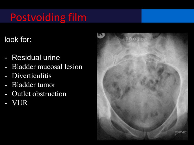 IVP, RGU & MCU | PPTX | Digestive Disorders | Diseases and Conditions