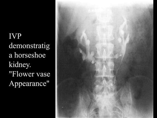 IVP, RGU & MCU | PPTX | Digestive Disorders | Diseases and Conditions