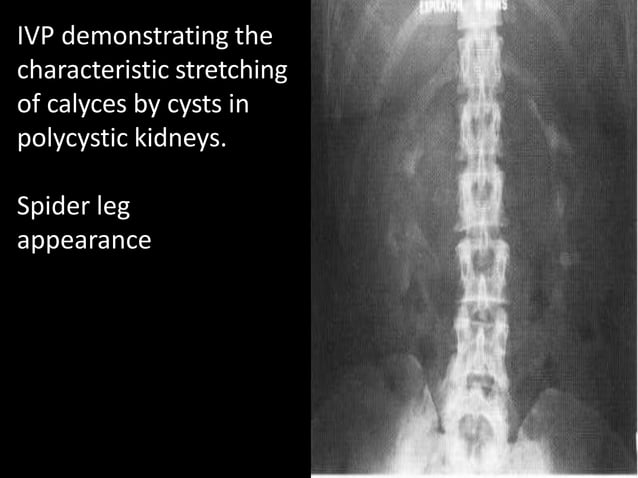 IVP, RGU & MCU | PPTX | Digestive Disorders | Diseases and Conditions