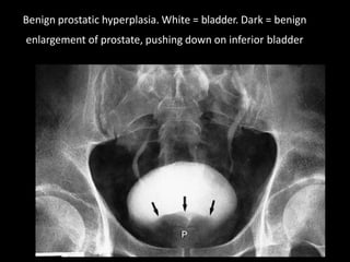 Benign Prostatic Hyperplasia X Ray
