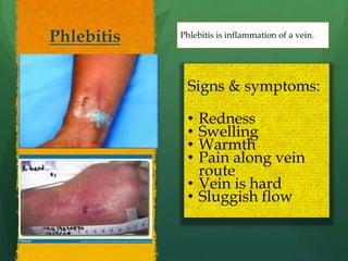 Iv Site Phlebitis
