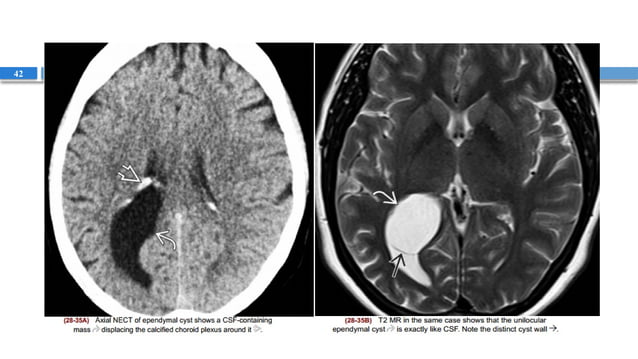 CNS Pathology of Intraventricular Tumor.pptx