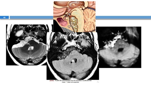 CNS Pathology of Intraventricular Tumor.pptx