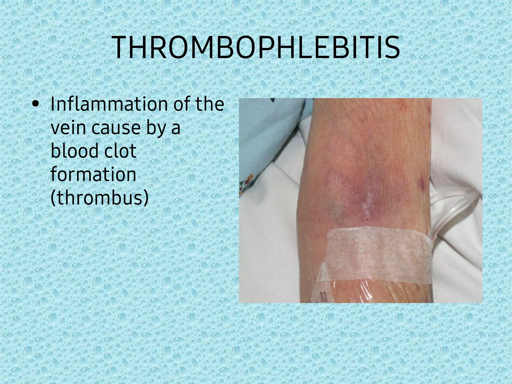 IVT COMPLICATIONS & MANAGEMENT(1).pdf