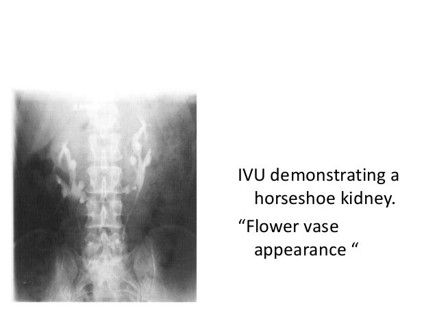 Intravenous urography