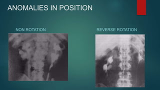 INTRAVENOUS UROGRAM ( IVU ) | PPTX