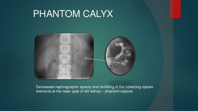 INTRAVENOUS UROGRAM ( IVU )