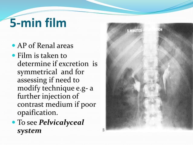 Intravenous urography | PPT