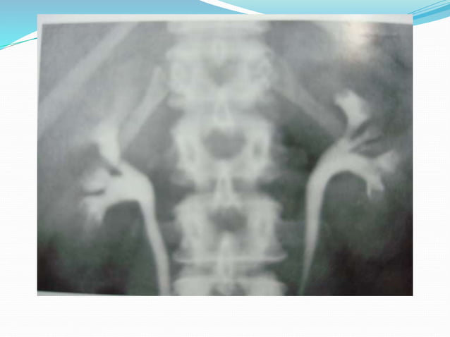 Intravenous urography | PPT