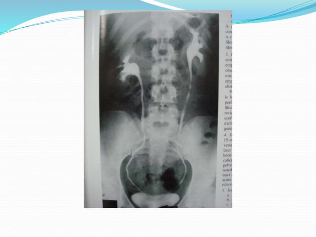 Intravenous urography | PPT