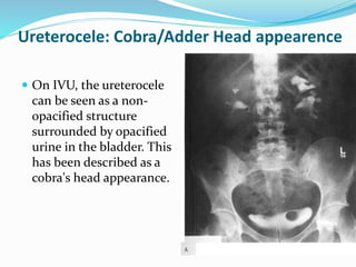 Ureterocele Adder Head
