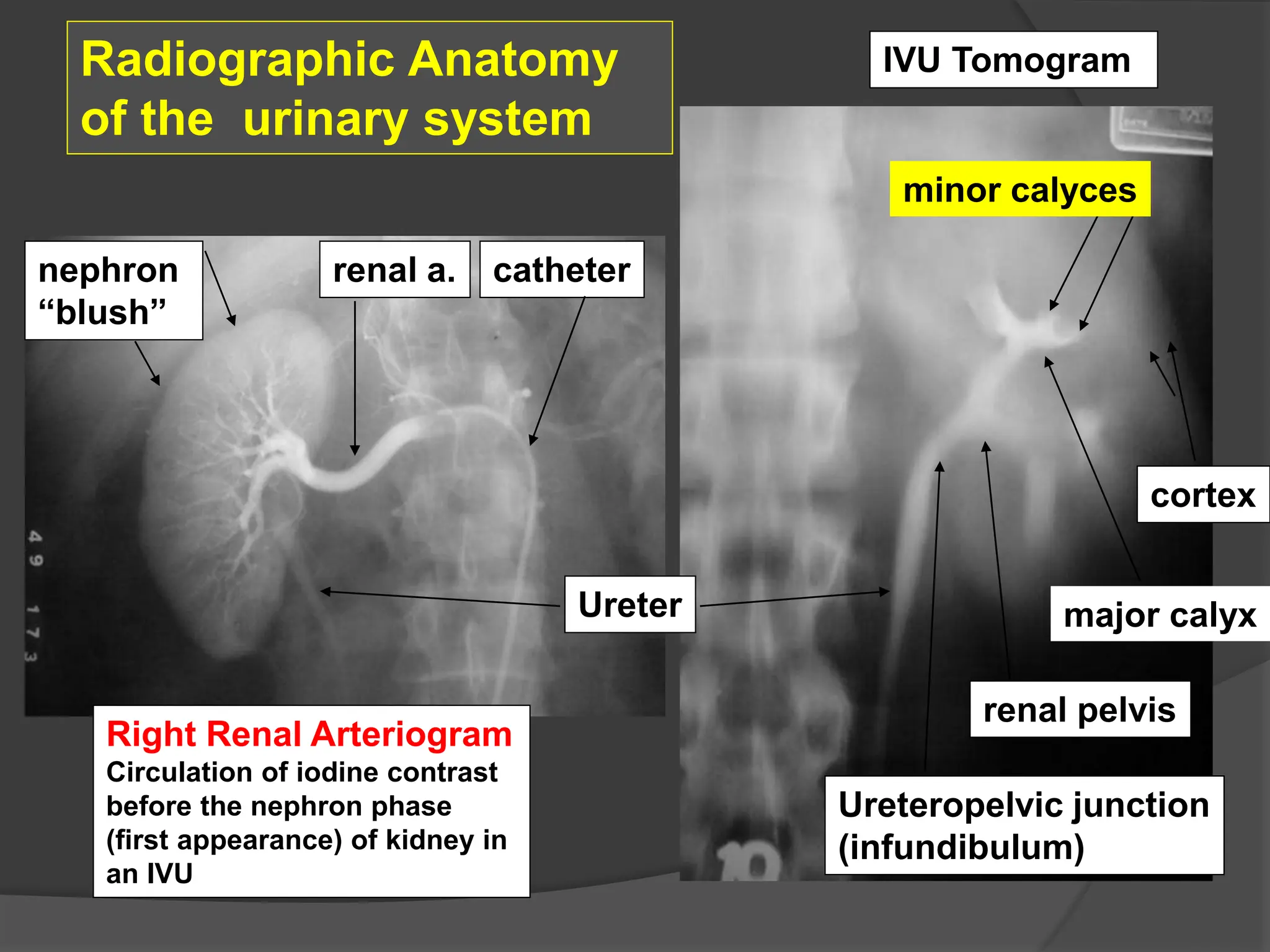 IVU contrasted studies - lecture....pptx