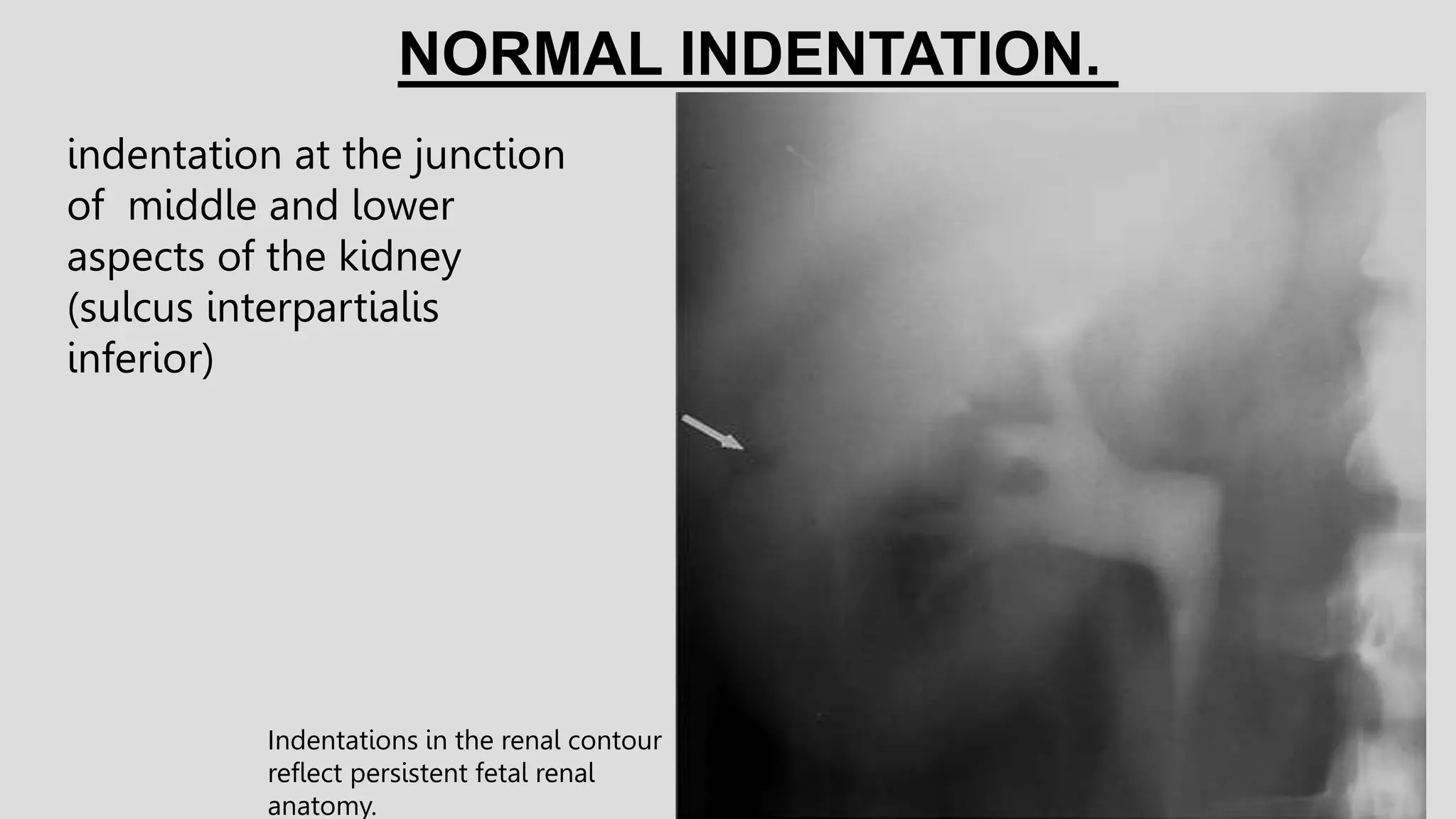 IVU FINDINGS.pptx