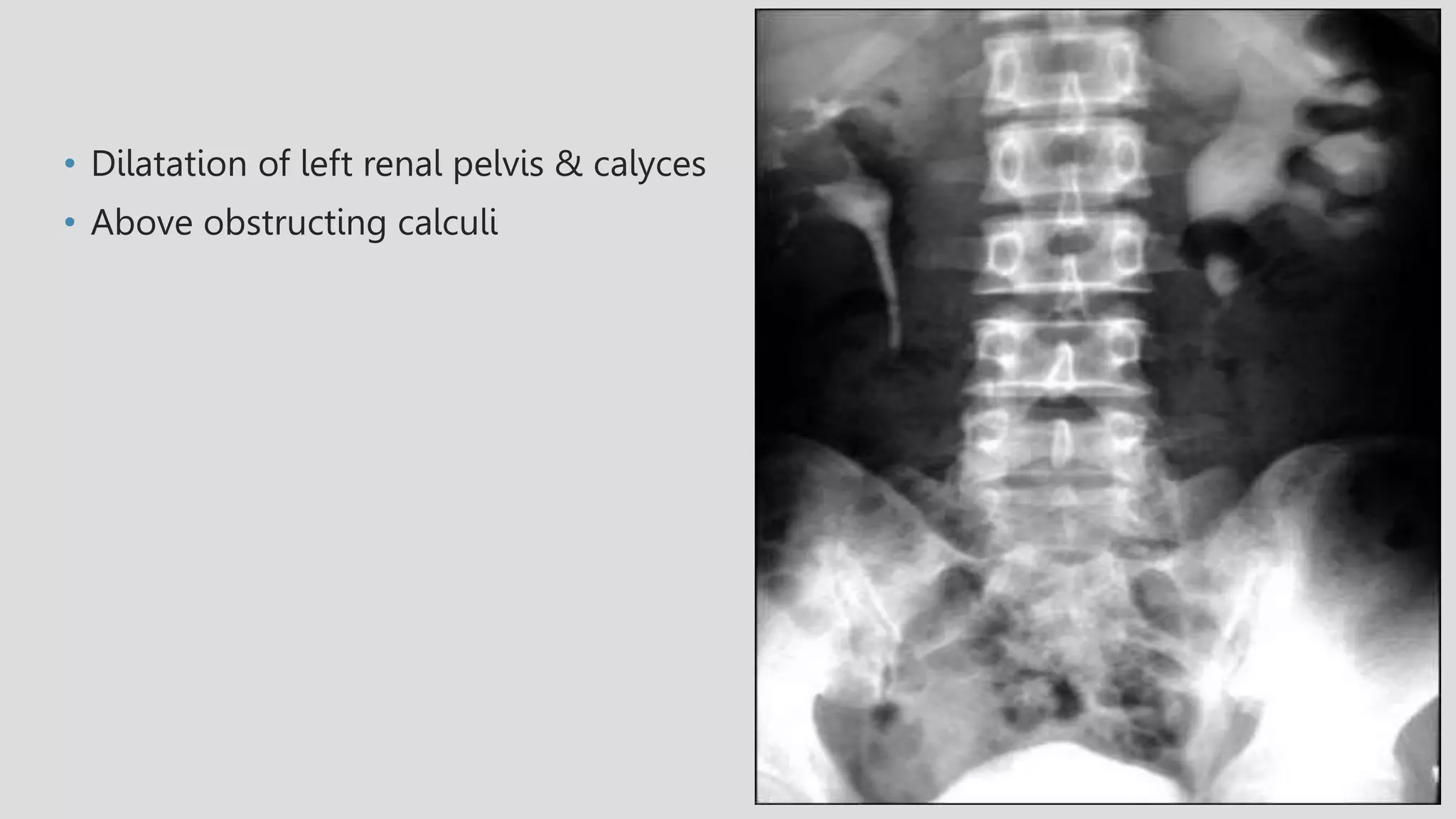 IVU FINDINGS.pptx