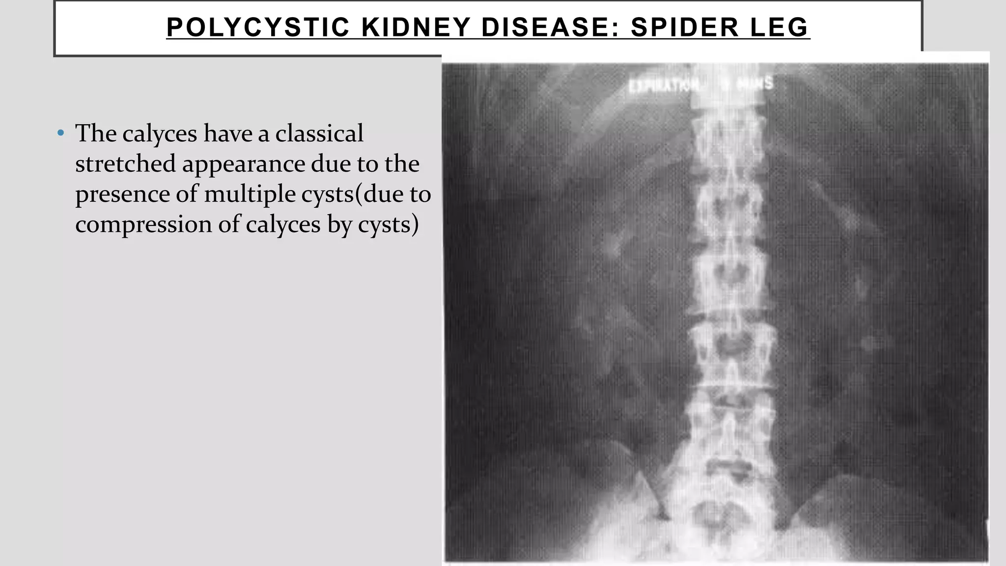 IVU FINDINGS.pptx