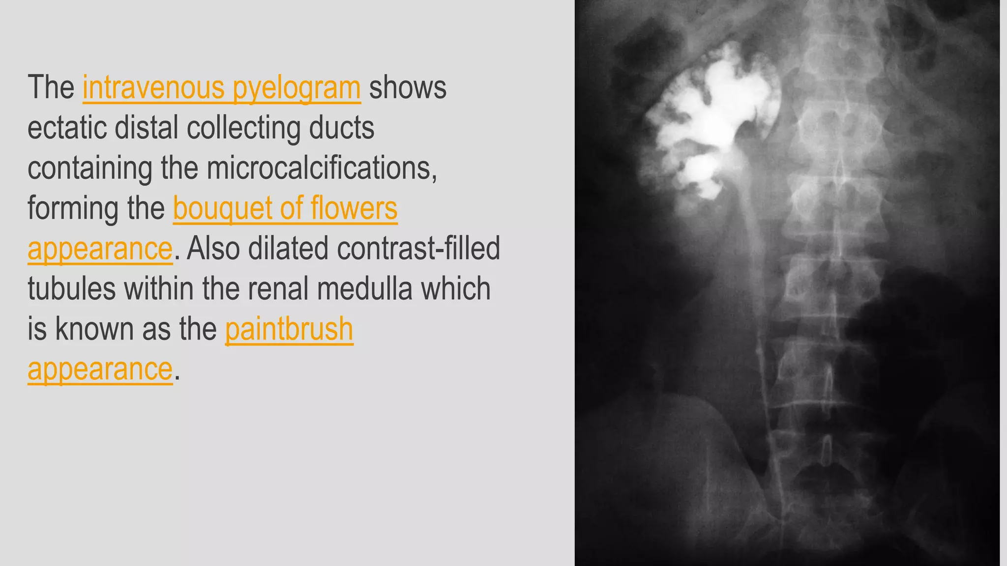 IVU FINDINGS.pptx