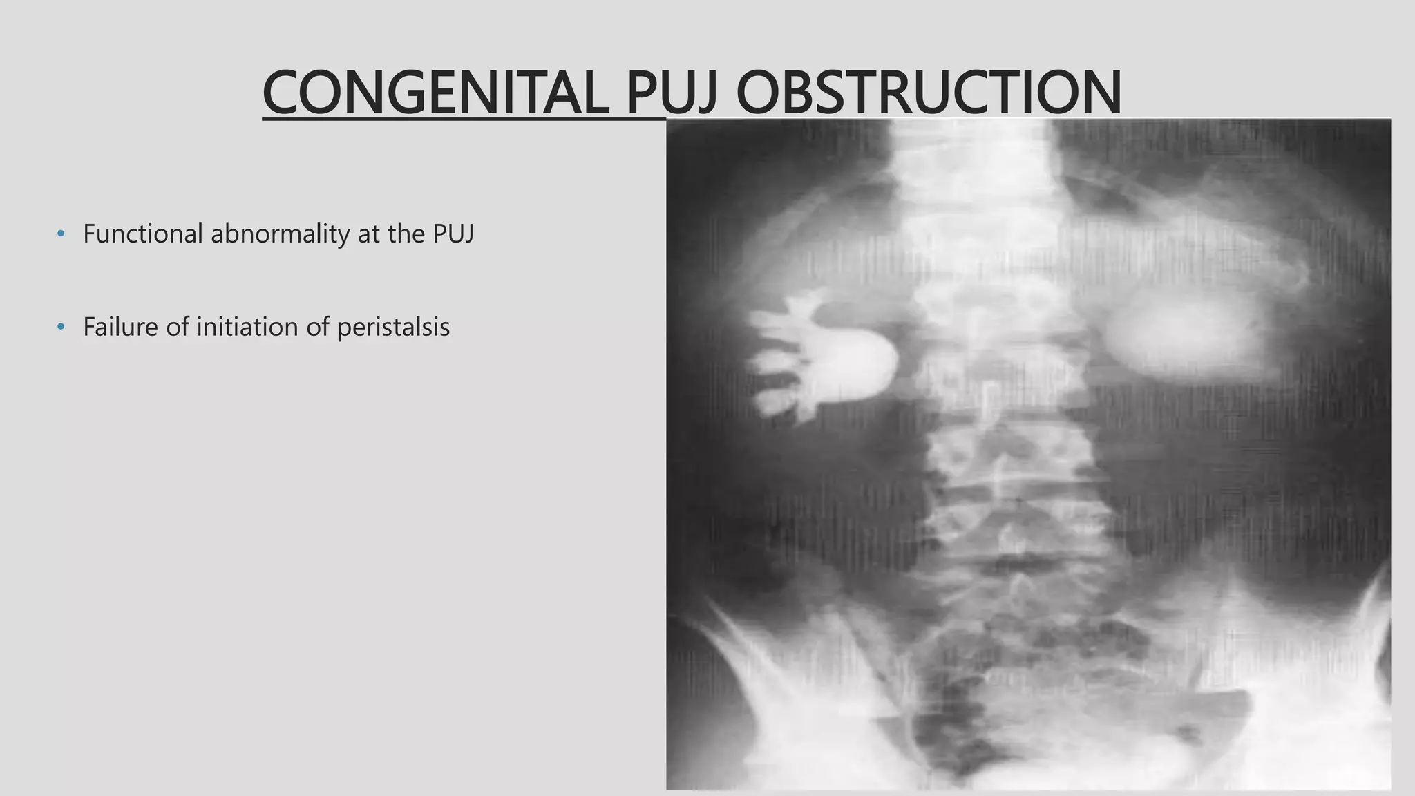 IVU FINDINGS.pptx