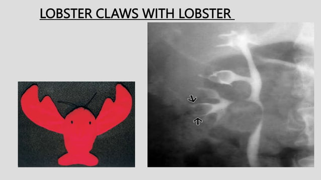 IVU FINDINGS.pptx