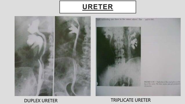 IVU FINDINGS.pptx
