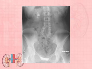 IVU lecture .....ppt | Medical Tests | Medical Health