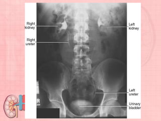 IVU lecture .....ppt | Medical Tests | Medical Health