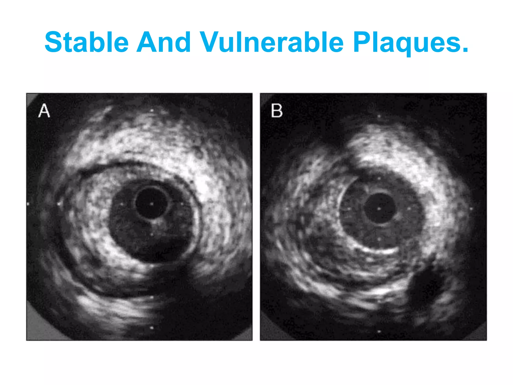 Ivus | PPTX